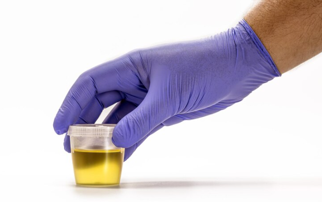 Yellow Urine: Understanding the Reasons and Remedies